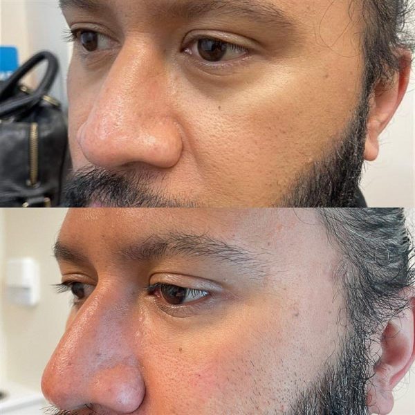 Tear Troughs - Botox Wellington – Wellington Cosmetic Clinic